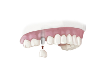 What Are Titanium Dental Implants And How Can They Benefit You?